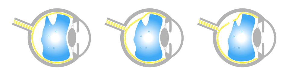 Augenarzt Dr. Pickl im Zentrum von Linz - Alle Kassen und privat